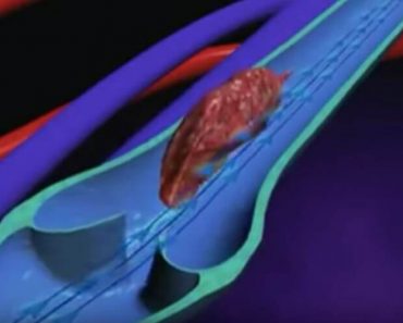 Tips en Weetjes longembolie