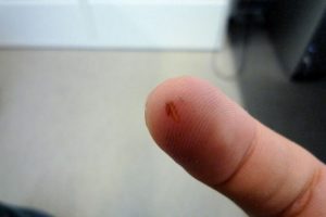 Handig: zo krijg je moeiteloos een splinter uit je huid